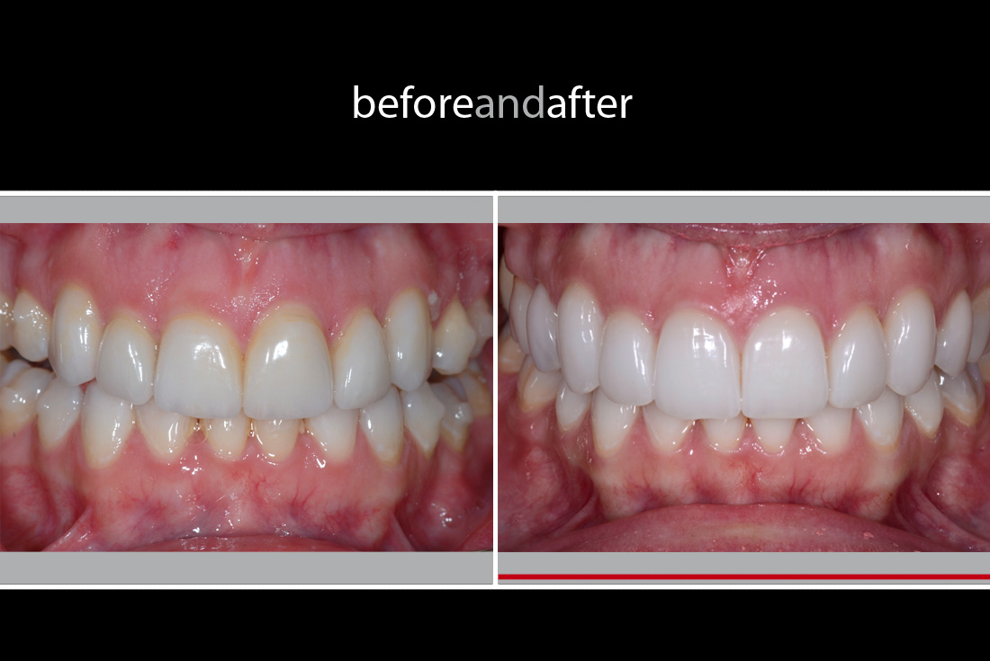 CORRECTION OF A MIDLINE CANT WITH A SINGLE CENTRAL INCISOR - Smile Virtuoso